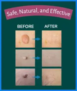 Alverox Wart Remover Review: Is It Worth It?